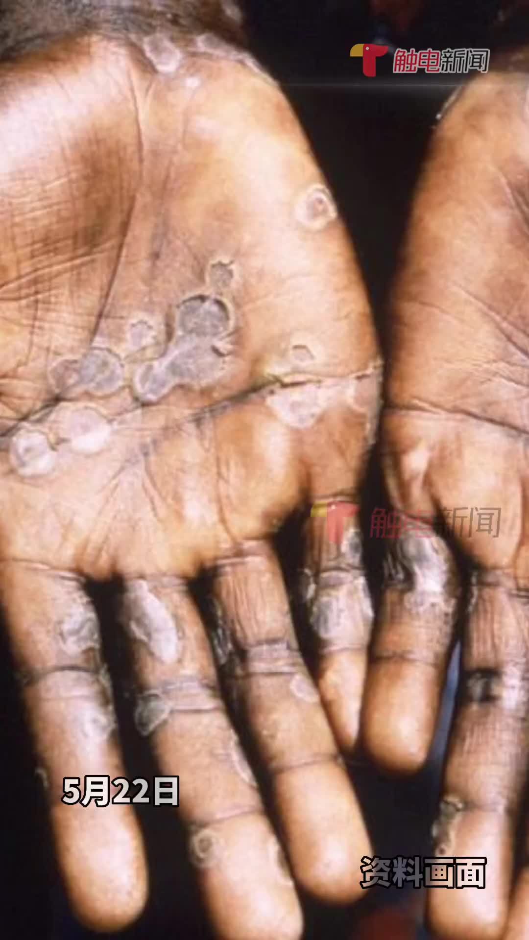 5月22日圣湘生物发文:已储备猴痘病毒核酸检测试剂盒,可快速鉴别出猴...