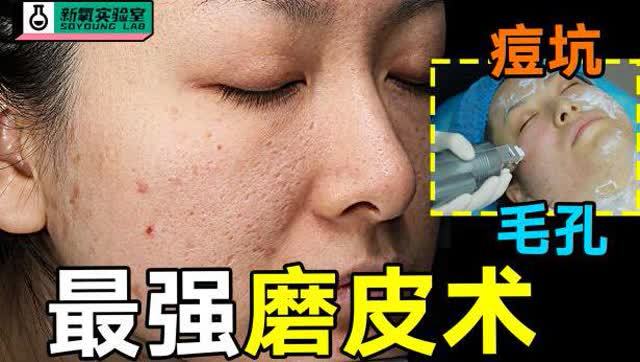 顽固痘坑痘印如何有效解决,一次黄金微针真能见效吗?
