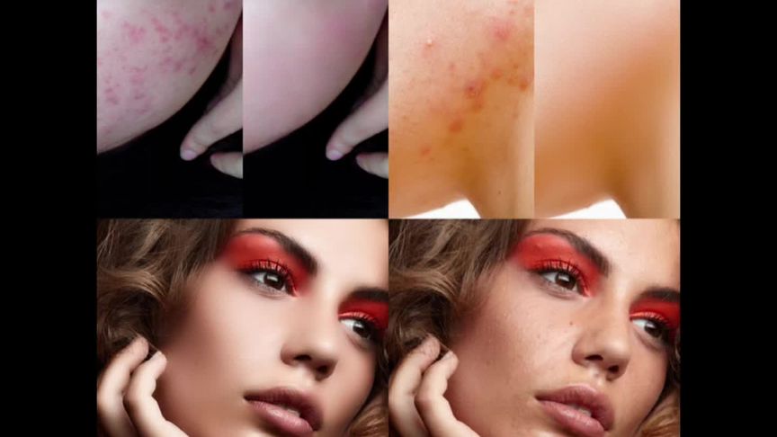 #拯救痘痘肌 #痘痘逆袭 ps下的你可还可以?#美图