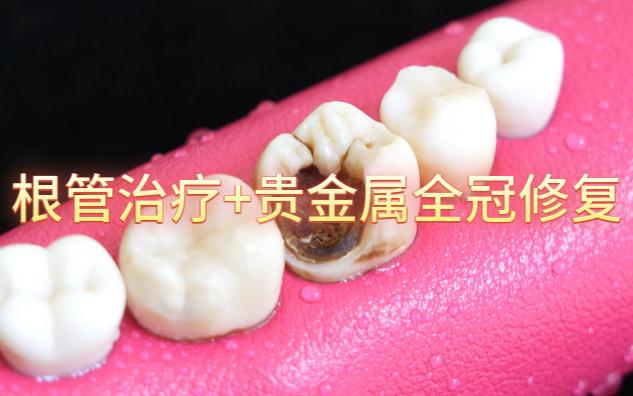 根管治疗+贵金属全冠修复
