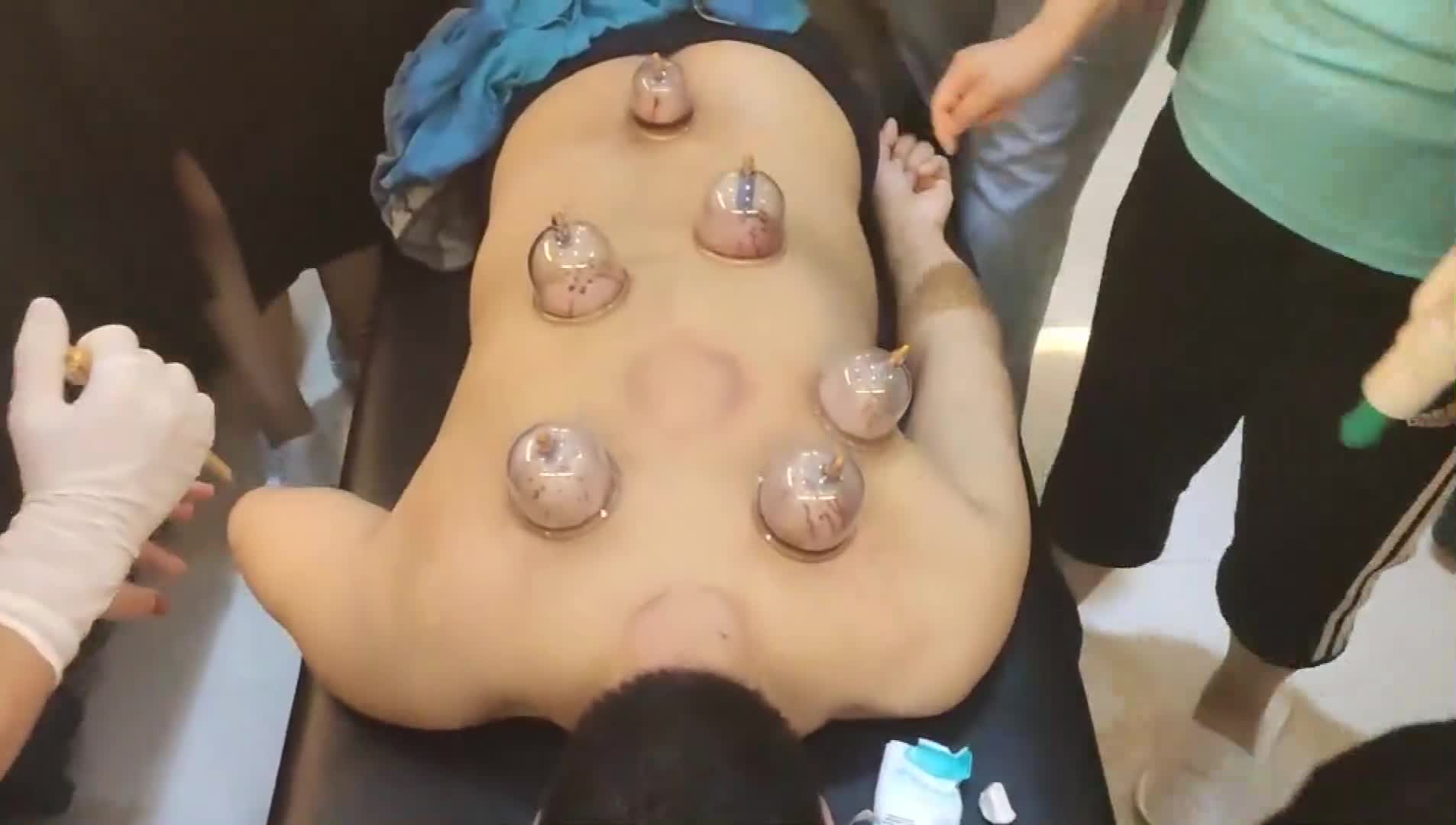 截根疗法放血疗法之背部放血