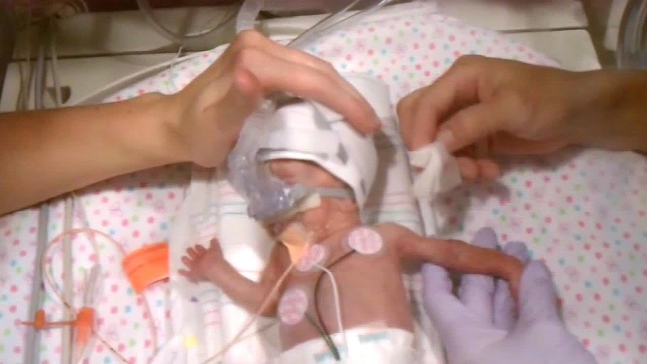 医生给30周的早产儿宝宝检查身体,宝宝的小手努力挣扎看着好心疼