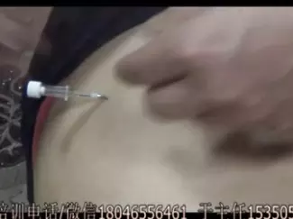 王启才浮针腕踝针--腰部的治疗--中医针灸、正骨、推拿、埋线减肥、...