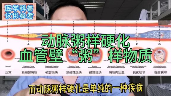 动脉粥样硬化和动脉硬化是一回事吗?什么是动脉硬化?