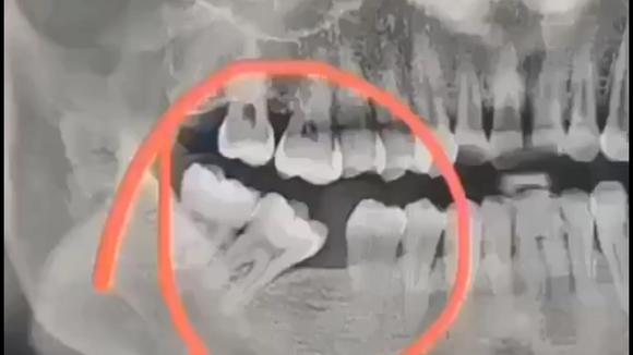 #吴医生口腔健康#缺牙一定要重视