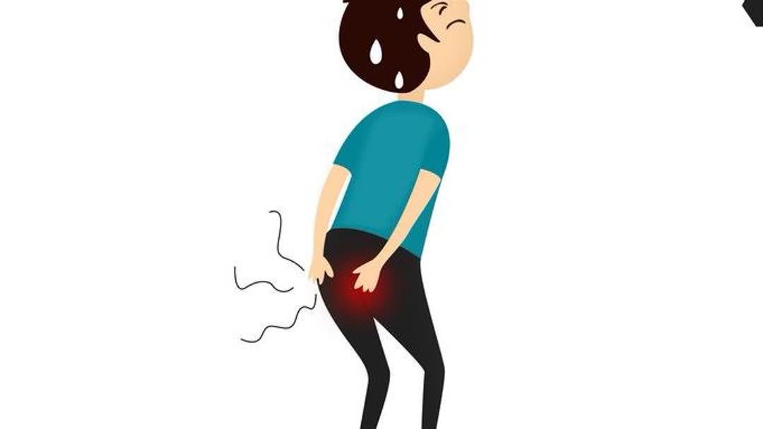 总感觉肛门不舒服,像夹了个东西?医生:这可能是外痔疮的表现