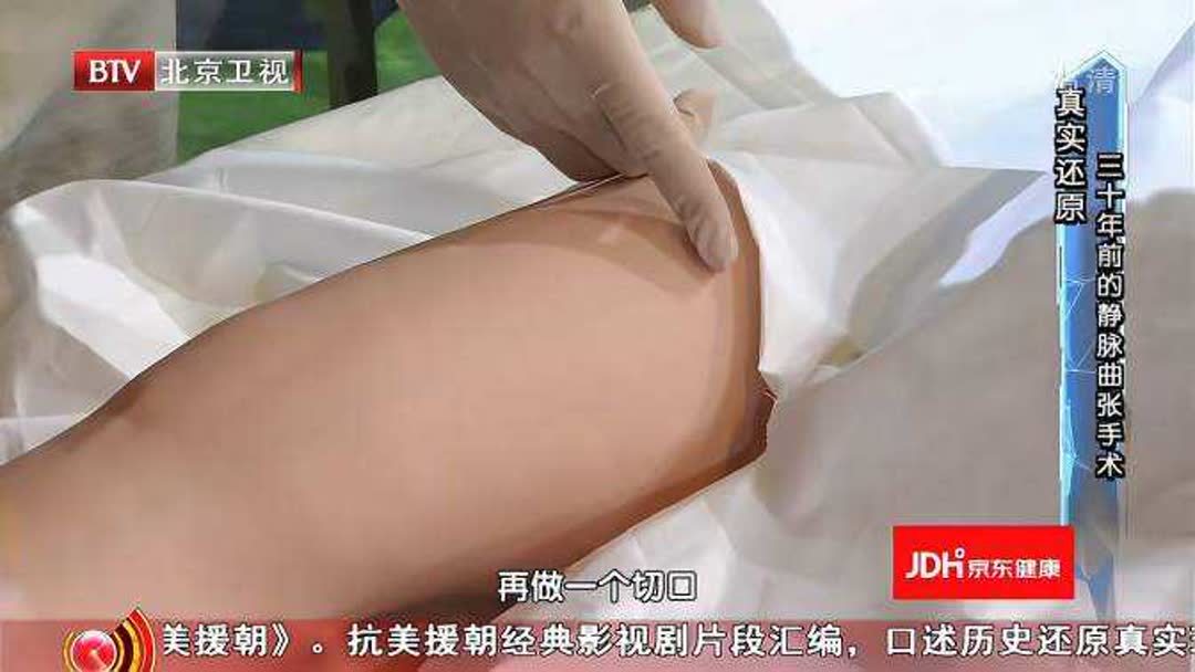 真实还原，三十年前医生做静脉曲张手术过程，令人毛骨悚然
