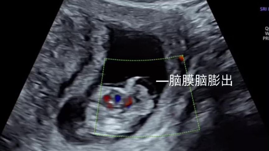 神经管畸形#孕期知识