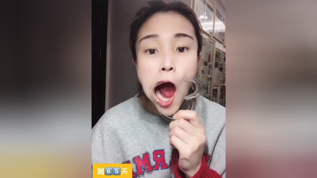 80后老阿姨牙齿矫正第65天!奇葩的“开口器”#牙齿矫正