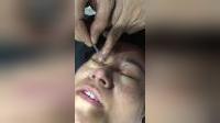 吴士杰无痛一针疗法:老花眼,眼干眼涩,近视眼