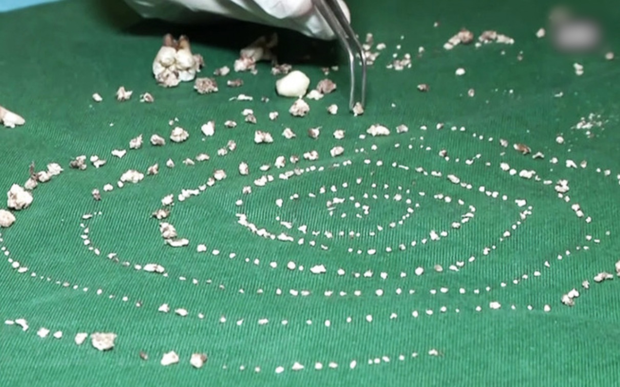 罕见!印度7岁男孩嘴里拔出526颗牙