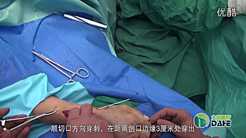 德国贝曼负压引流装置临床应用操作之桡骨远端骨折切开复位内固定...