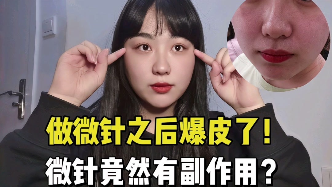 做微针之后爆皮了?微针竟然有副作用?