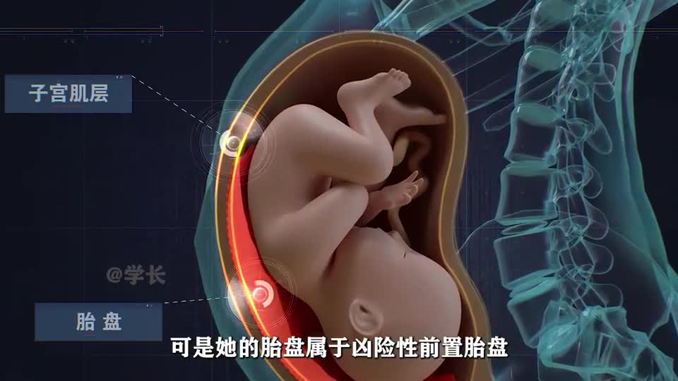 高龄产妇产后大出血,真实纪录片