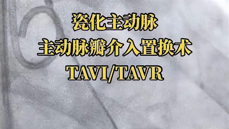 主动脉瓣介入置换术