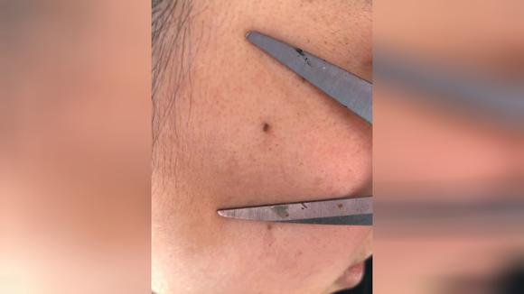 怎样祛除脸上身上讨厌的痣,简单的一个小方法帮你解决