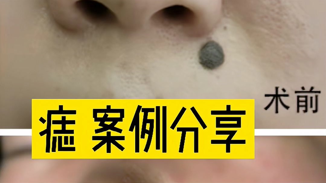 色素痣如何去除:精细手术是关键