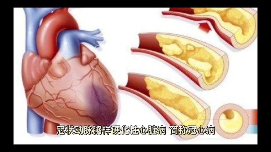 一分钟教会你如何识别早期冠心病表现