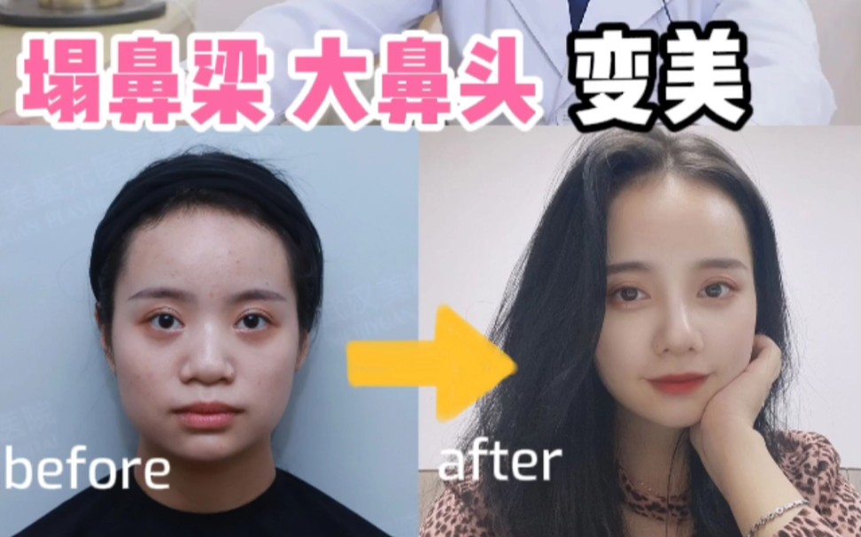 鞍鼻变美分享,如何改善塌鼻梁,大鼻头?塌鼻子,会显得面部中庭凹陷,...