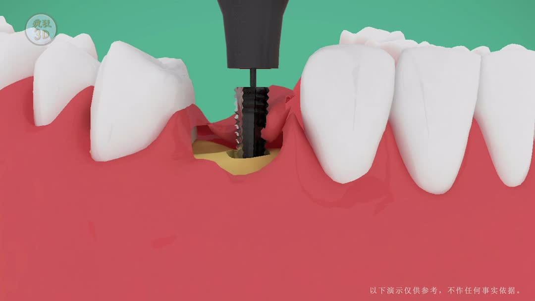 3D动画演示:种牙过程,看着牙齿好痛啊,好好刷牙吧以后