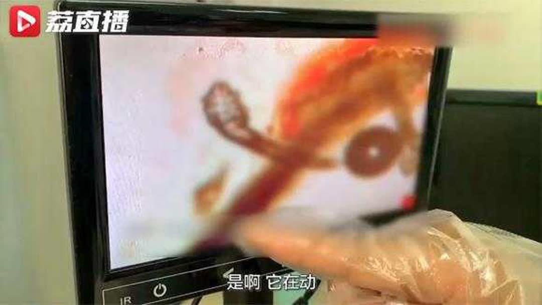 女孩眼睛干涩发痒,竟是睫毛里长了螨虫