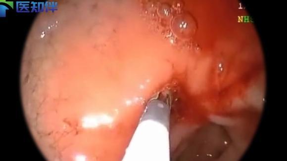 胃内镜电凝止血,小小的孔可能会要了你的命