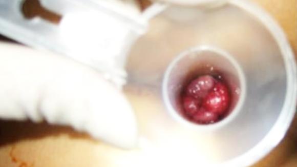 什么是痔疮?得痔疮是怎样一种体验?