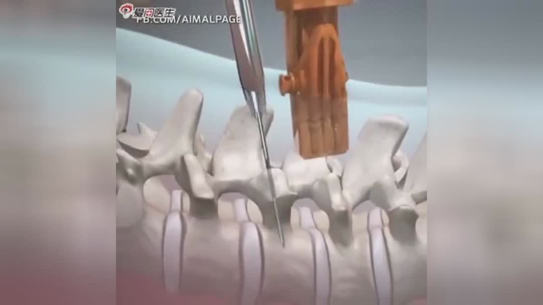医学3D动画演示:机器人辅助下的损伤脊髓手术