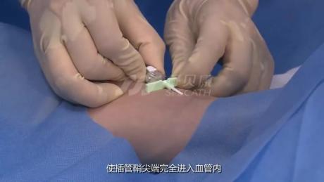 舒贝康PICC导管盲穿视频