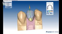 Implant Zr Abutment 种植牙锆基台Ceramill_mind_mplant_STEP8