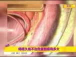苏州治痔疮最好的医院-苏州同济医院-痔疮的症状表现