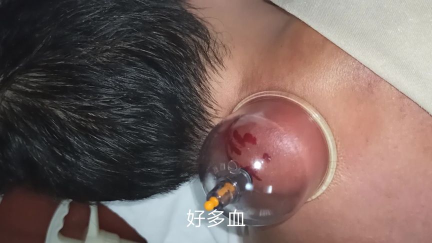 拔血罐不知道大家见过没,嘟嘟第一次见看的可紧张了