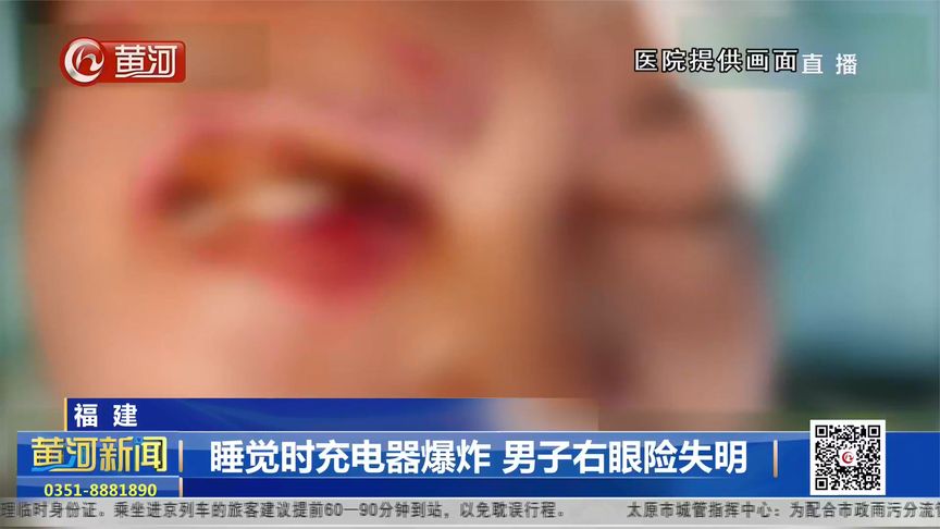 男子正在睡觉时,充电器突然爆炸,右眼受伤十分严重!