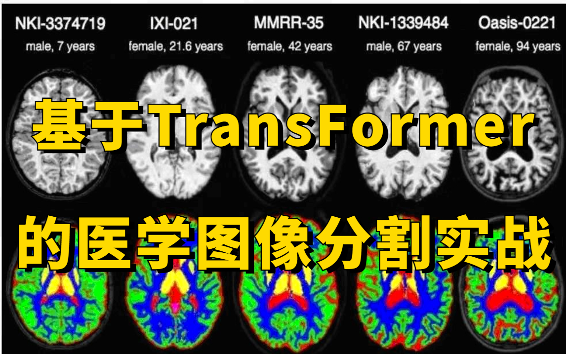 席卷CV界的Transformer到底有多牛!基于Transformer的医学图像分割...