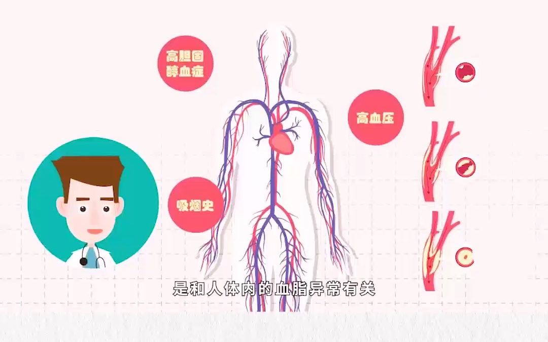 心内科动画科普之动脉粥样硬化 哈尔滨治动脉粥样硬化的医院