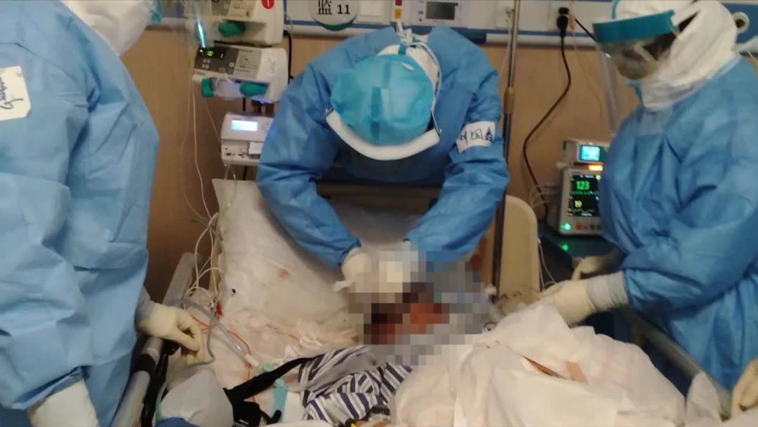 ICU病房内的生死1分钟:医生一个动作夺回新冠患者生命