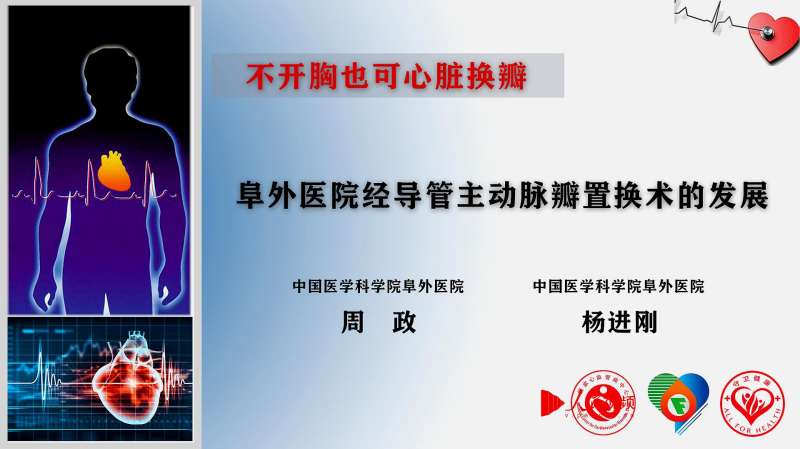 阜外医院经导管主动脉瓣置换术的发展