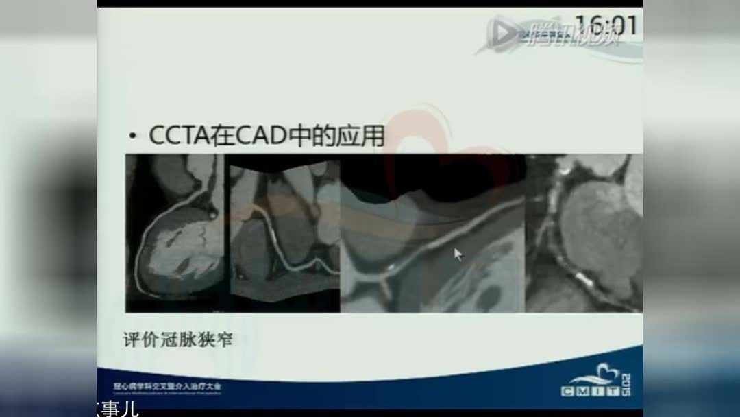 听影像大咖讲:冠脉CTA成像之外的那些事儿