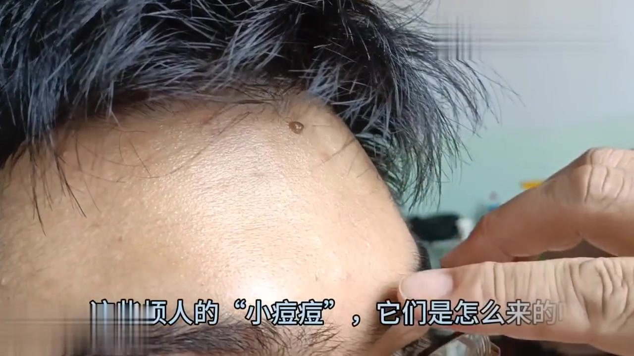 听五院皮肤科侯文超大夫讲讲小痘痘--关于"痤疮"的科普知识