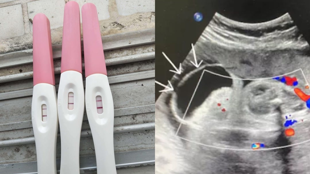 怀孕5月产检看B超单懵了!胎儿屁股竟长“尾巴”,夫妻崩溃后生下