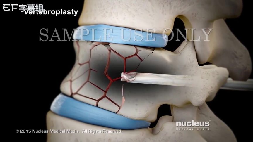 医学3D动画演示:椎体压缩骨折后的常用手术方式——椎体成形术