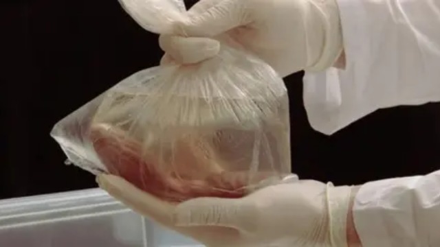 做手术时切下来的器官,最后医生都是如何处理掉的?看完长见识了