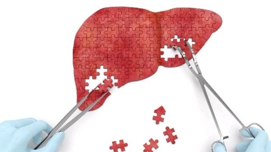 脂肪肝不是大病?医生提醒不及时处理,会遇到这些"大麻烦"!