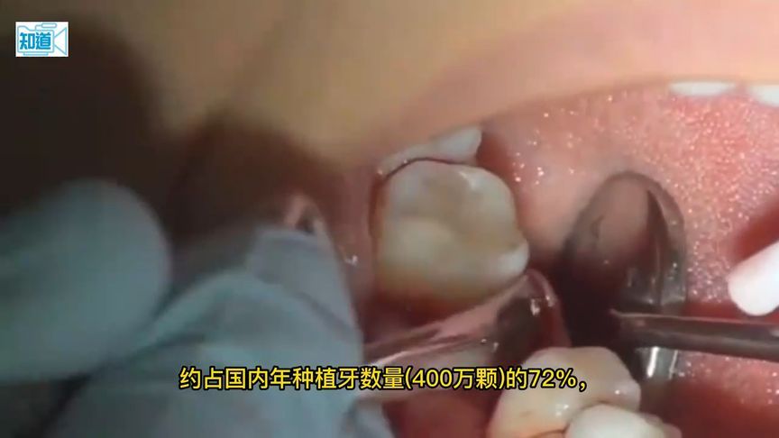 种植牙集采开标 一颗牙的整体费用有望降低50%左右