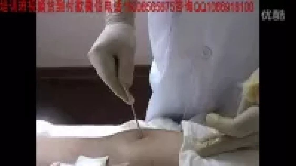 陈超然 拨针 疗法 针灸培训班教程_02