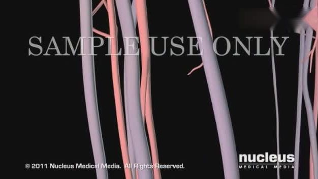 深静脉血栓和肺栓塞-3D医学动画