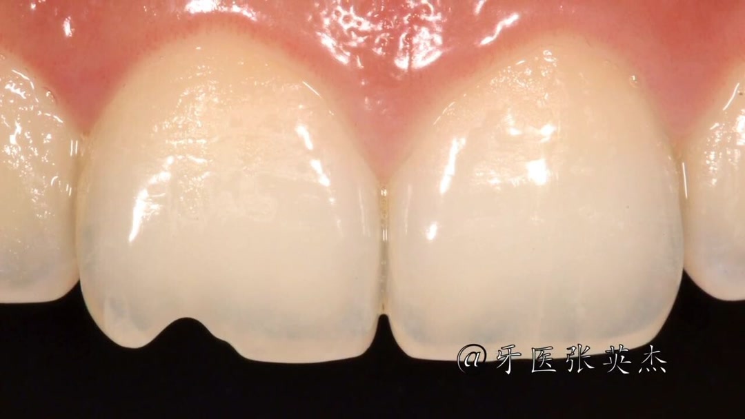 口腔美学修复病历分享