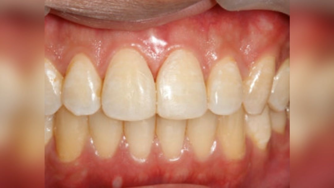 口腔种植 初级零基础进阶高级 取模植骨实操理论 牙科视频课程