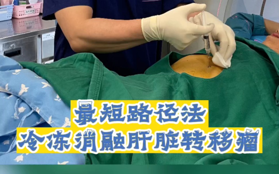 最短路径法冷冻消融肝脏转移瘤