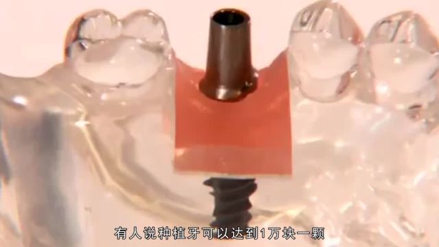 一颗种植牙1万块真的值吗?看下种植体的生产过程,答案一目了然
